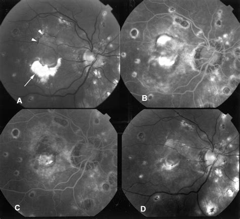Treatment Of Subfoveal Choroidal Neovascularization Associat Retina