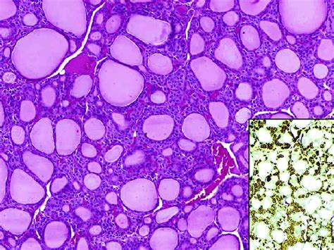 34 Diffuse C Cell Hyperplasia Rat There Is A Diffuse Increase In C