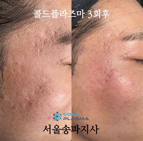 이 You Tube 강남플라즈마는 이곳이 맞습니다 구jnco 잠실점 확장오픈 수강및 시술 문의상담 환영