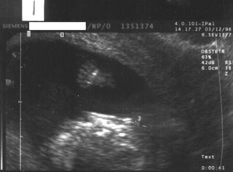 Chondroectodermal Dysplasia Diagnosed By First Trimester Ultrasound