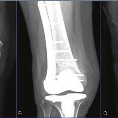 In Case 3 The Patient Sustained A Rorabeck Type Ii Distal Femoral Download Scientific Diagram