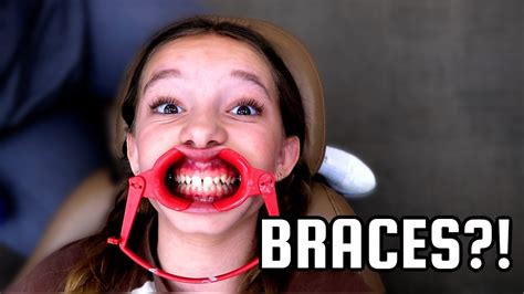 London Got Braces And Surprised Everyone Youtube