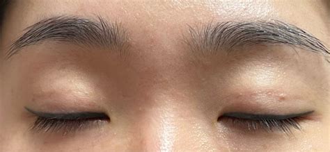 의사에게 물어보세요 매몰 쌍수한지 일주 강남언니 1등 성형수술and피부시술 정보앱