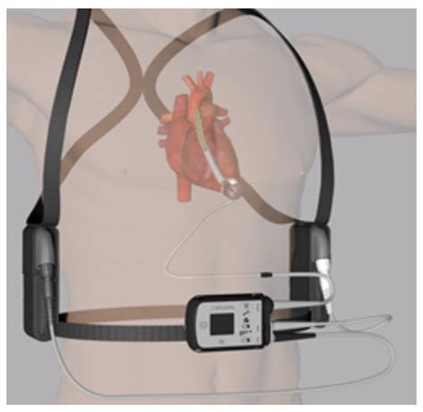 Non Pulsatile Ventricular Assist Devices