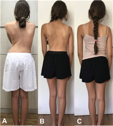 A Posterior Pre Brace View B And C Posterior View During Medical Download Scientific Diagram