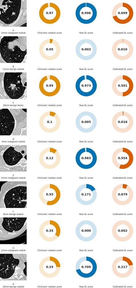 Pulmonary Nodule Malignancy Risk Calibration Diagnostic Image Analysis Group