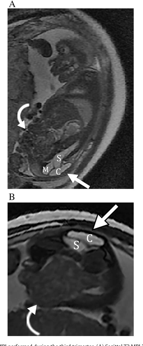 Figure 1 From Fetal And Neonatal Presentation Of Oeis Complex Semantic Scholar