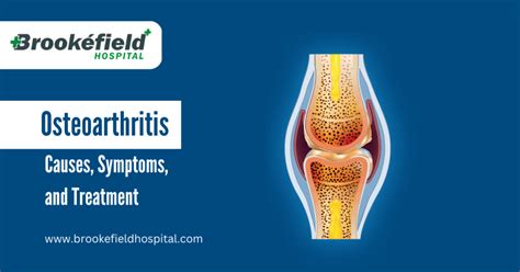 Osteoarthritis Causes