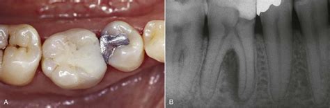 Recurrent Caries