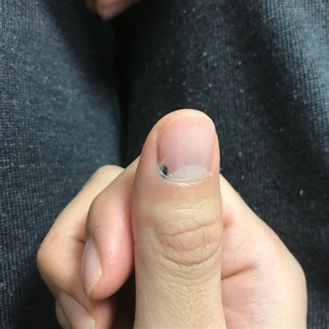 엄지손톱에 검은색 점 지식in