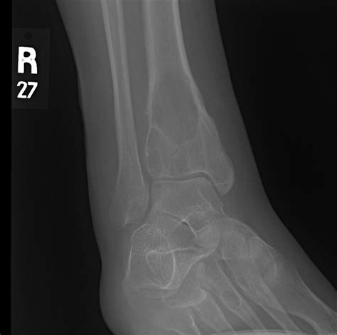 Radiopaedia Case Giant Cell Tumor Distal Tibia Id 16266 Study