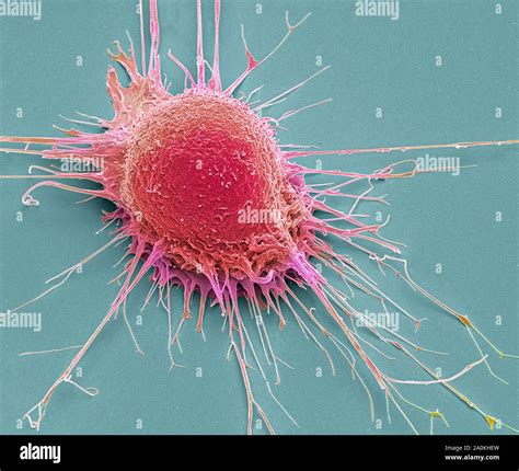 Cancer Cell Under Electron Microscope