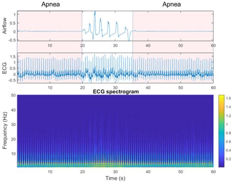 Sleep Apnea Classification Algorithm Development Using A Machine Learning Framework And Bag Of