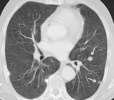 Computed Tomography Showing The Multiple Metastatic Nodules In The Lung Download Scientific