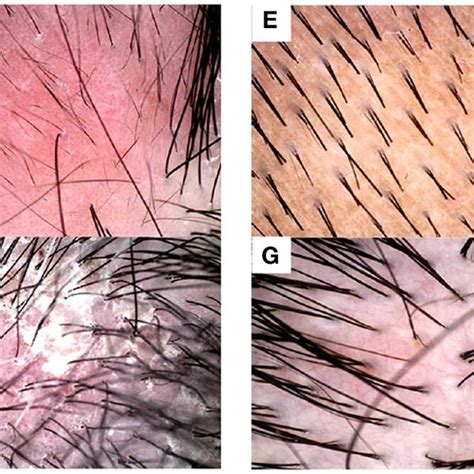 Examples Of Typical Dermoscopic Images Typical Images From Ad
