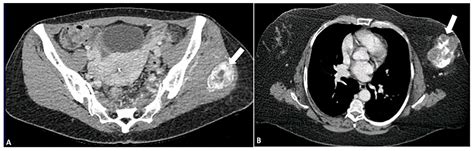 Pictorial Review Of Soft Tissue Lesions With Calcification