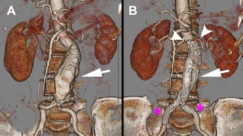 Endovascular Abdominal Aortic Aneurysm Repair Evar Smartinject Solutions