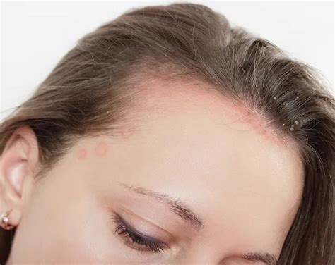 Dandruff Treatment In Singapore Tsn Dermatology Clinic
