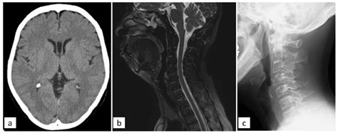 Imaging Results For Case Study 1 Patient A Head Computed Tomography Download Scientific