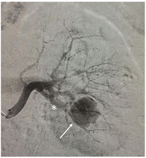 Angiogram Confirmed Pseudoaneurysm Arrow With Its Afferent Vessel