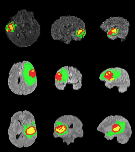 Segmentations Generated Via E1d3tta For 25 Th Percentile Top Median