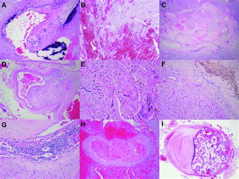 Histological Features Of Brain Arteriovenous Malformations A Download Scientific Diagram