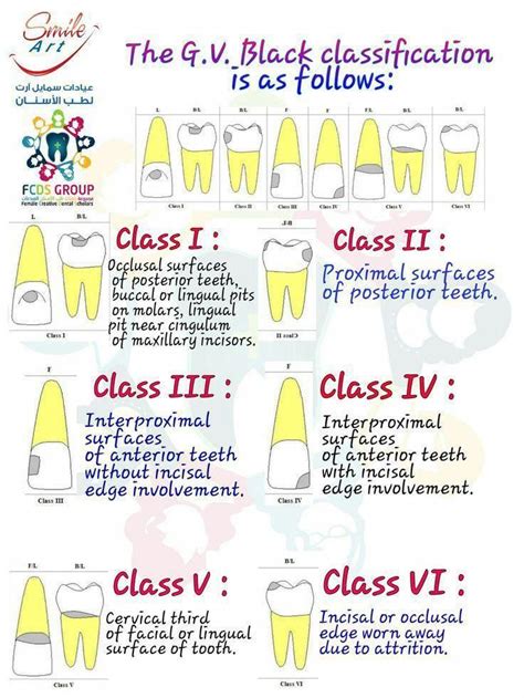 Dental Caries Classification Gv Black At Jacob Espinoza Blog