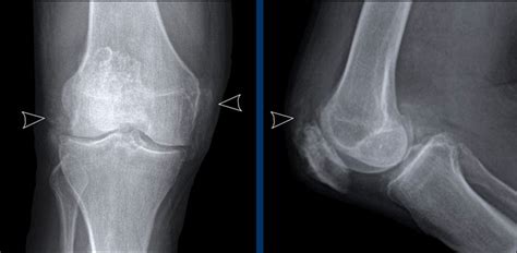 Gout Knee Xray 3d Segmentation Shows Promise In Knee Mri Exams