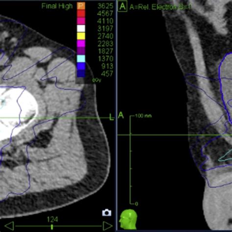 Sbrt For Localized Prostate Cancer The New Standard Of Care In Switz