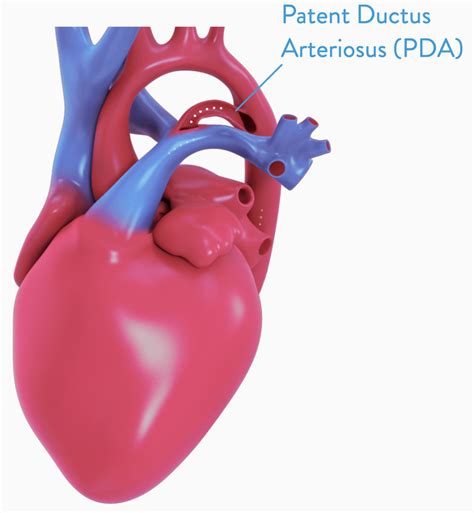 Patent Ductus Arteriosus Treatment Pda Closure