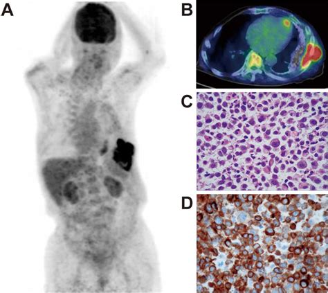 Pyothorax A Unique Case Of Tension Empyema Caused By Prevotella