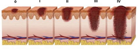 როდის იქცევა ჩვეულებრივი ხალი მომაკვდინებელ სიმსივნედ დაიმახსოვრეთ ეს ნიშნები ამით სიცოცხლეს