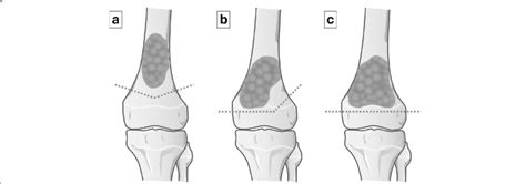Diagram Showing The Classification Of Tumor Excision To Preserve The Download Scientific
