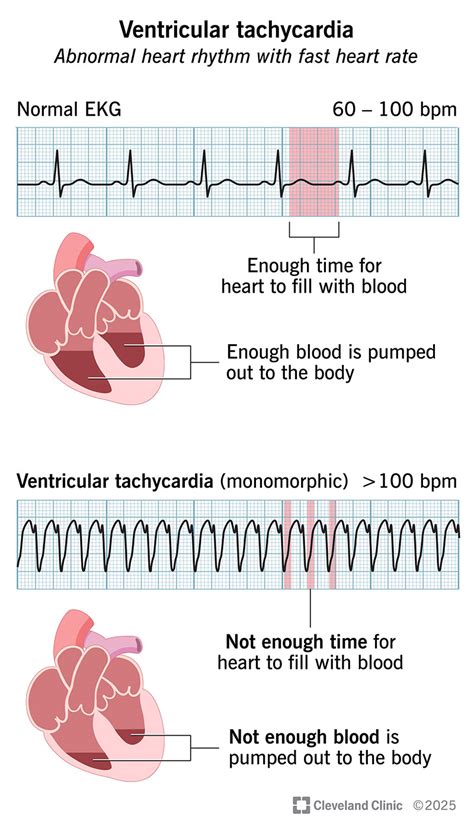 Ventricular Rhythm