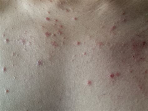 붉은 반점 여드름 지식in