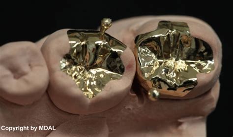 Gold Restorations Muellers Dental Arts Laboratory