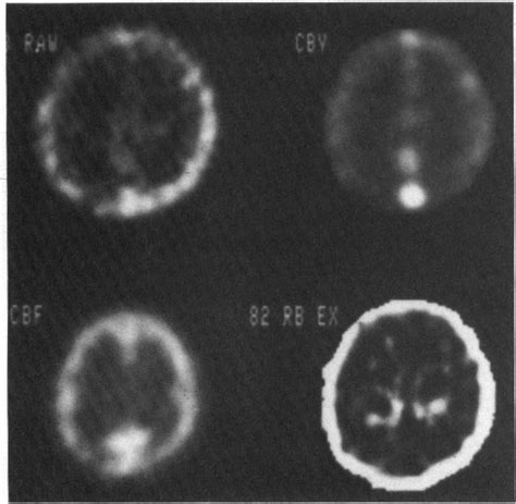 Attenuation Corrected Rb Uptake Scan And Regional Cbf Regional Download Scientific Diagram