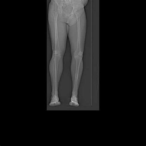 Case Study Left Total Knee Replacement 63 Year Old Female