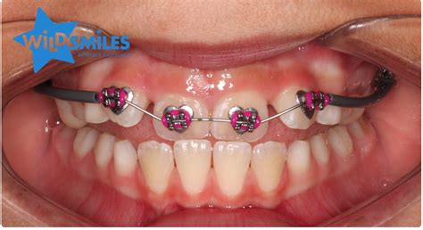 WildSmiles Braces Embrace Your Expression