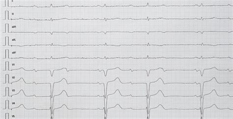 Explore Third Degree Av Block Treatment And Complications