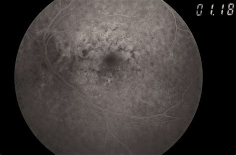 Reticular Pattern Dystrophy
