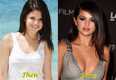 Selena Gomez Plastic Surgery Boobs Breast Enhancement Face