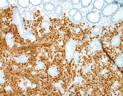 Diffuse Large B Cell Lymphoma Light Micrograph Stock Image C046 3111 Science Photo Library