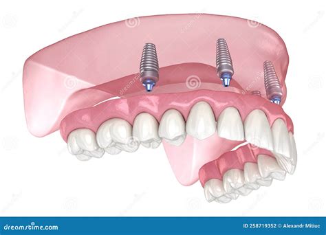 Maxillary Prosthesis With Gum All On 4 System Supported By Implants Medically Accurate 3d