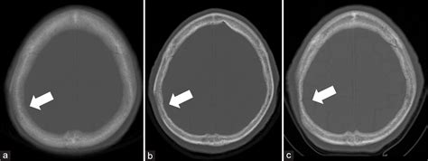 Surgical Neurology International