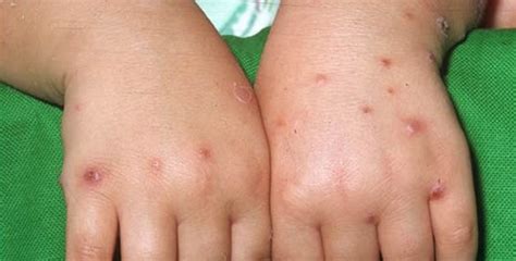 Prurigo Simplex Acuta Infantum Zdravlje