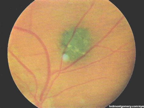 What Is The Icd 10 Code For Choroidal Nevus