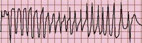 Ekg Identification Flashcards Quizlet