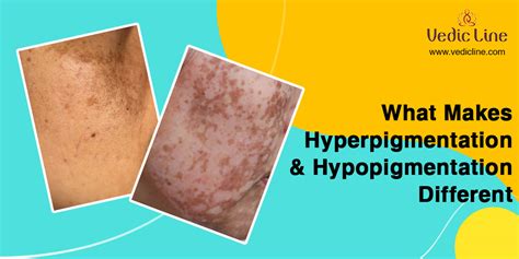 Hypopigmentation