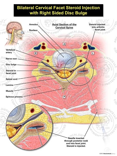 Bilateral Cervical Facet Steroid Injection With Disc Bulge